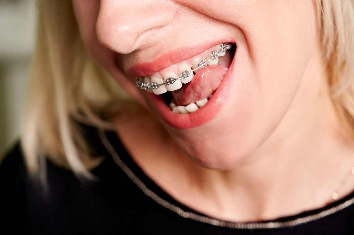 Types of Braces and Their Benefits - From Metallic to Ceramic